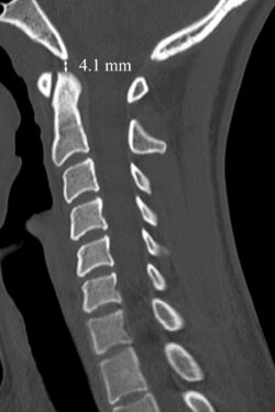 Basion-dens interval (BDI)