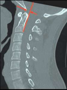 Basion-axial Interval (BAI)